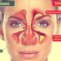Sinusite chronique et ostéopathie
